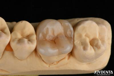 Cina Aspetto naturale Emax Inlay Onlay Restauro dentale duraturo 0,5 mm 1 mm 1,5 mm Spessore in vendita