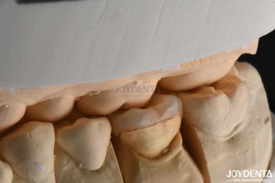 Cina Aspetto naturale Emax Inlay Onlay Restauro dentale duraturo 0,5 mm 1 mm 1,5 mm Spessore in vendita