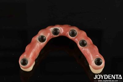 China Dental Titanium Malo Implant Bridge Combining Traditional And Modern Techniques for sale