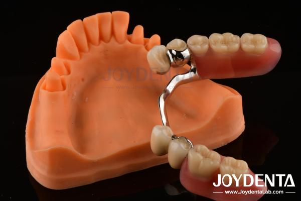 Impianto strutturale Denti di finitura Tecnologia elaborata Belle aspetto armonioso Disegno