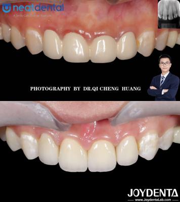 China Hoge doorschijnendheid meerlagig zirconia kroon voor voorste achterste tanden scheurbestendige Te koop