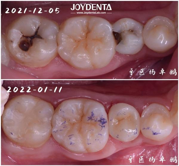 Quality High Durability Inlay Dental Restoration For Damaged Tooth Various Sizes Available for sale