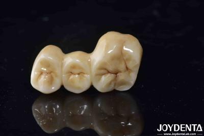Cina Alta biocompatibilità Coroa di zirconia a contorno completo Perfetta vestibilità Alta resistenza in vendita