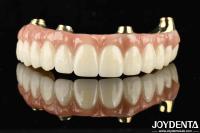 China Functionality Ti-Bar Compatible With Natural Teeth And Gums Restores Chewing Function for sale