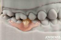 China Flexible Denture Finish Personalized Customization and Advanced Tooth Arrangement Technology for Customized Needs for sale