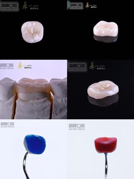 Quality Experience The Precision Of Dental Inlay Affordable And White For Perfect Fit for sale
