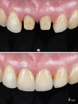 China Las carillas hechas con alta resistencia a la fractura de zirconia dental y tecnología de gradiente multicapa for sale