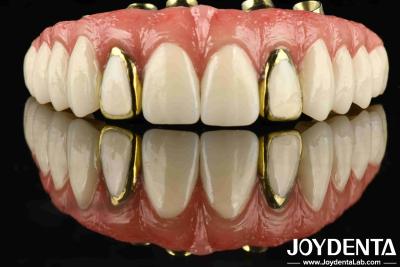 China Experience The Durability Of Titanium Malong Hybrid Bridge For Applicable Dentistry for sale