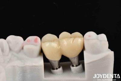 Cina Impianto dentale in porcellana personalizzabile con ponte e corona per un'estetica eccezionale in vendita