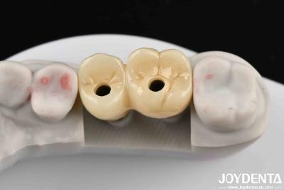 Cina Impianto dentale in porcellana personalizzabile con ponte e corona per un'estetica eccezionale in vendita