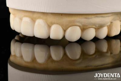 Cina Ceratura diagnostica estetica biomimetica per faccette in vendita