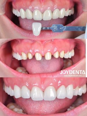 중국 자연 치아 를 흉내내는 지르코니아 치아 판매용