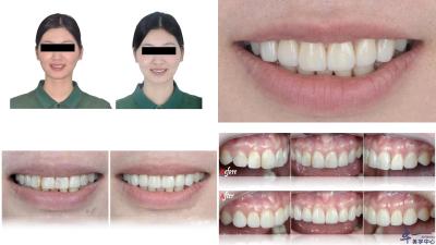 Китай Популярные продукты Joydentalab: симулированные эстетические фанеры продается