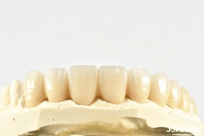 China Revolutionize Aesthetics & Strength: Introducing Our Multi-Layered Chromatic Zirconia Bridge for sale