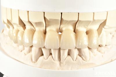 China Revolutionize Aesthetics & Strength: Introducing Our Multi-Layered Chromatic Zirconia Bridge for sale