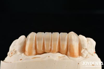 China Unveil True Biomimicry: Introducing Our Multi-Layered Zirconia Aesthetic Bridge for sale