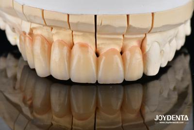 China Unveil True Biomimicry: Introducing Our Multi-Layered Zirconia Aesthetic Bridge for sale