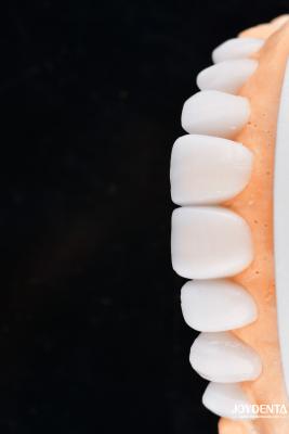 China Enhance Case Acceptance & Patient Communication with Our Diagnostic Wax-Up Service for sale