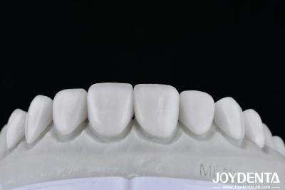 China Visualize the Result, Secure the Case: Our Diagnostic Wax-Up Service for sale