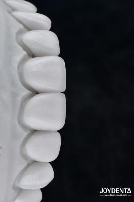 China Visualize the Result, Secure the Case: Our Diagnostic Wax-Up Service for sale