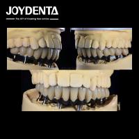 China Titanium Multiple Teeth Dental Implant Prosthetic Surgery External Hexagon Connection for sale
