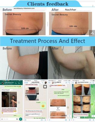China professional cryolipolysis fat freezing machine home device fat freeze with ce&ISO for sale