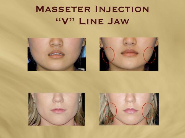 V-Line Masseter Injection with Botox® ("Square Jaw" reduction) - Aesthetics Hawaii