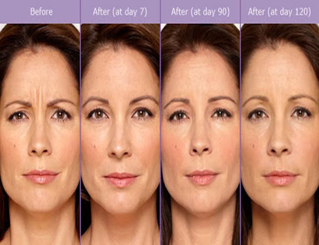 Botulinum Toxin Injections for Wrinkle Reduction Innotox botox botulax rentox nabota 2