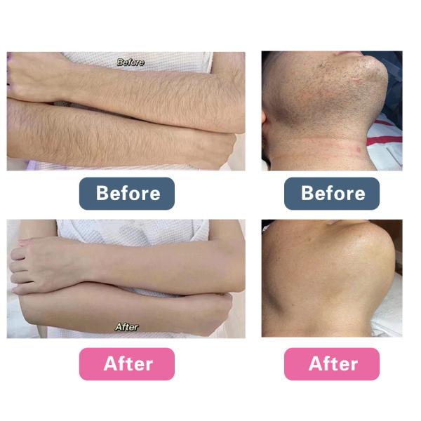 Quality 3500W Picosecond Laser Machine 500ps-900ps Pulse Width For Skin Whitening for sale