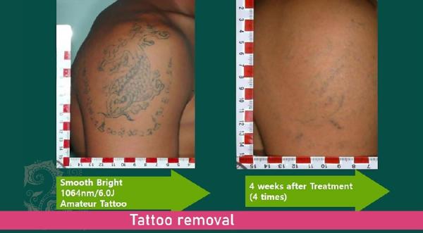 Quality Picosecond Laser Facial Rejuvenation Machine , Q Switched Tattoo Removal Machine for sale