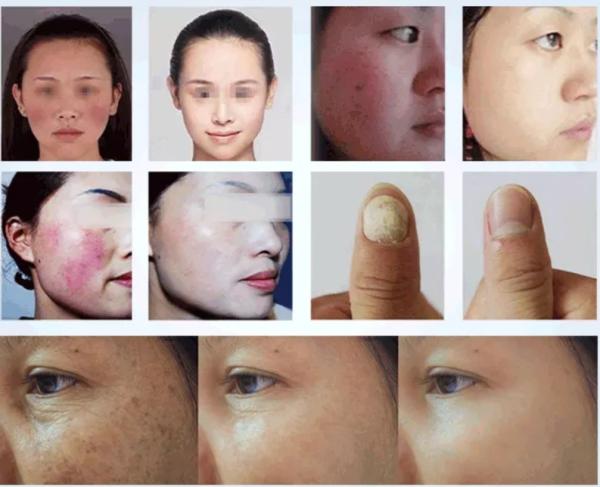 Quality 50W 980 Nm Diode Laser Spider Vein Removal Machine For Blood Vessel Treatment for sale