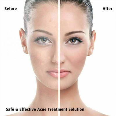 Cina Toppa idrocolloide amichevole del brufolo dell'acne del vegano per la copertura Zits in vendita