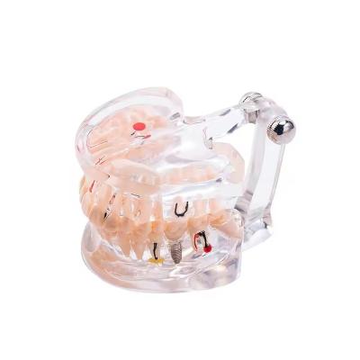 Cina 32 denti mese intero malattia degli impianti dentali modello di progettazione chiara modello di patologia dentale in vendita