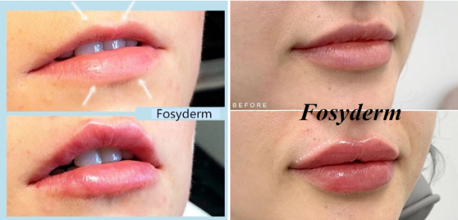 Juvederm Ultra3