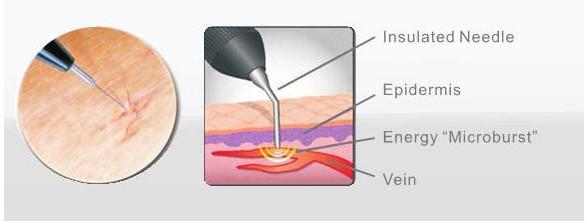 Immediatamente macchina di trattamento del laser delle vene varicose di rimozione della vena del ragno di risultato/strumenti chirurgici vascolari