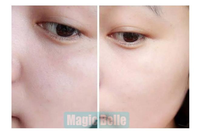 Micro machine hydro massage jet peel machine Korea small bubble for home use