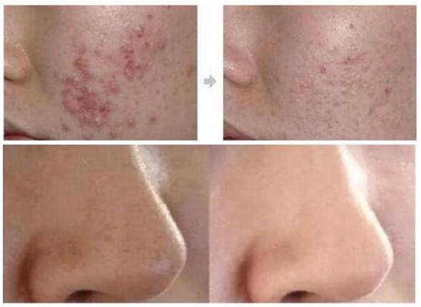 Super suction water dermabrasion peel with 3 bottles hydro dermabrasion (CE)