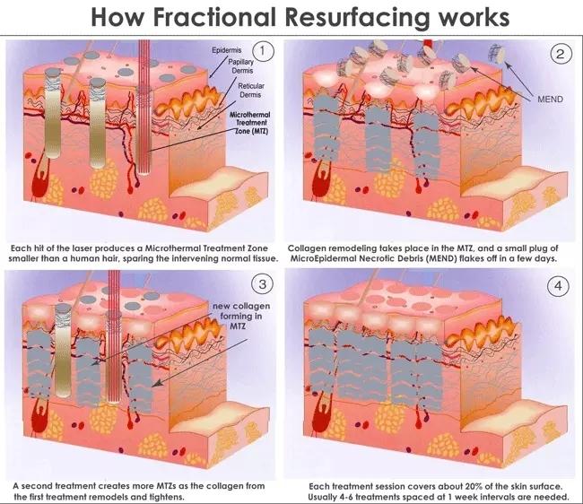 a42577e20c3715bf900eee5ecae1468b_fractionalCO2laser(8).jpg