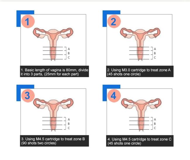 2021 Professional HIFU Vaginal Machine High Intensity Focused Ultrasound HIFU Vaginal Tightening Rejuvenation Skin Care Beauty Machine CE