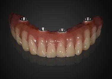Implant restoration