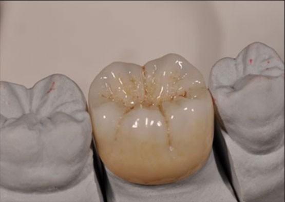 Noritake Zirconia