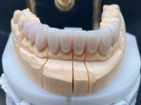 China Dental Lab E Max Ceramic Crown High Translucent with Corrosion Resistance for sale