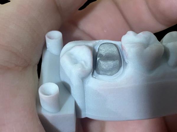 Corrosion Resistant Metal Post And Core High Adhesion For Dental Restoration