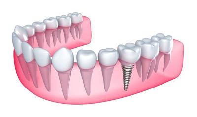 China Permanently Affixed Dental Implants Austin With No Extra Maintenance for sale