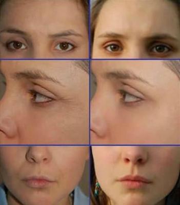 China 100%pure Hyaluronic acid filler for Derm deep wrinkle for sale