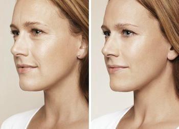 China Reduce wrinkle Hyaluronic acid filler for facial dermal for sale