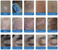 China Psoriasis Vitiligo Excimer Laser for sale