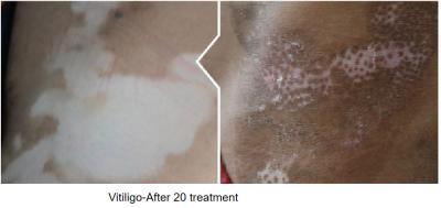 China Homeuse 308nm Vitiligo Excimer Laser Targeted Treatment Excimer Light for sale