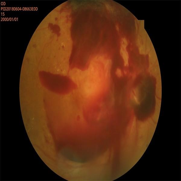 High Resolution Automated Fundus Camera with FFA or FAF, mosaic function