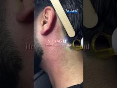 Diode Laser vs ND YAG Laser, which one you prefer?